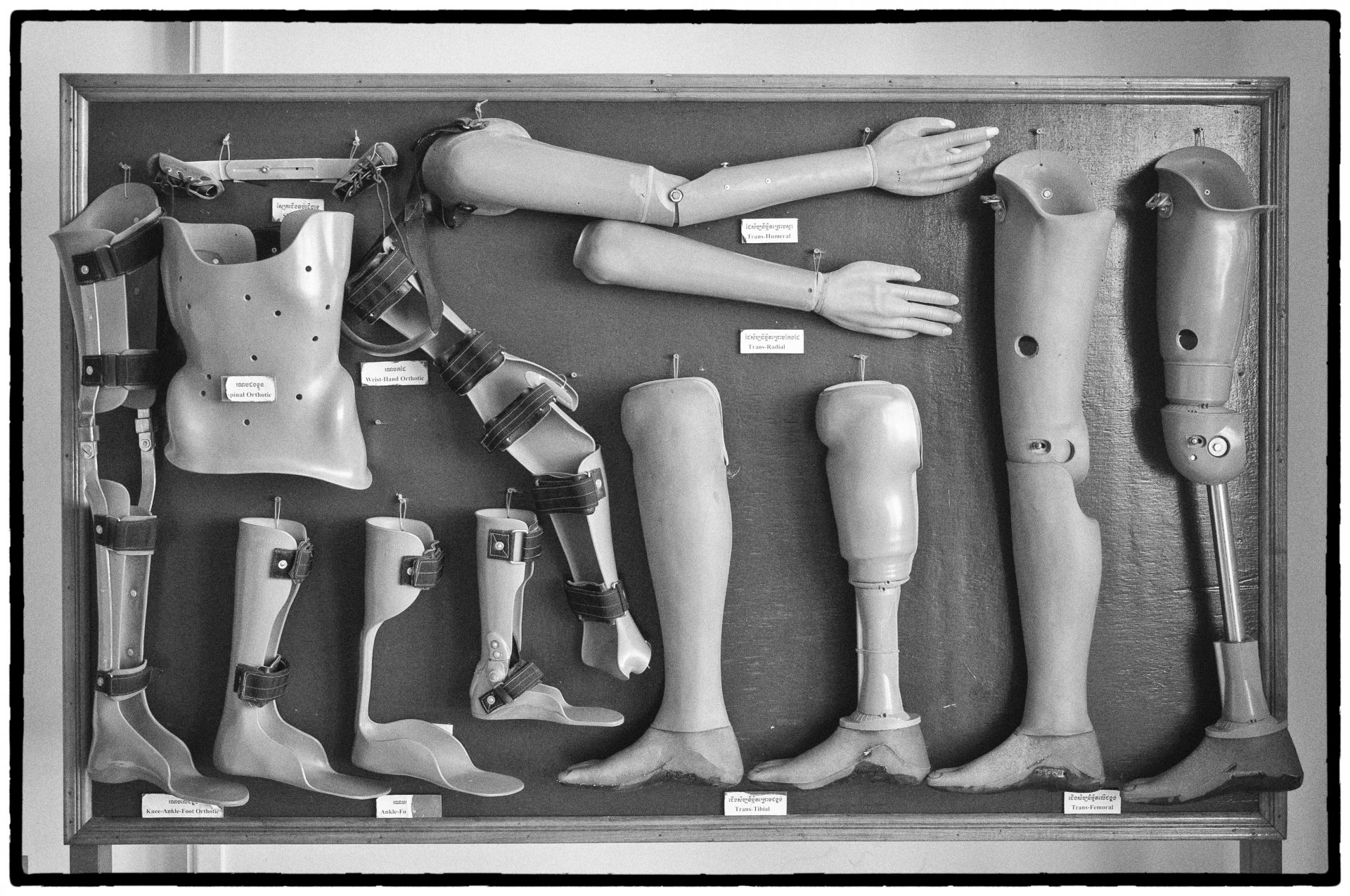 Exceed Prosthetic & Orthotics – Cambodia - Glen Howey Photography